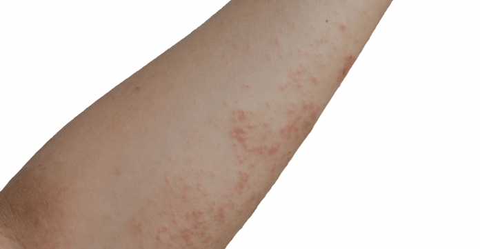 Vyrážky na rukách - Čo ich spôsobuje a ako sa ich zbaviť?
