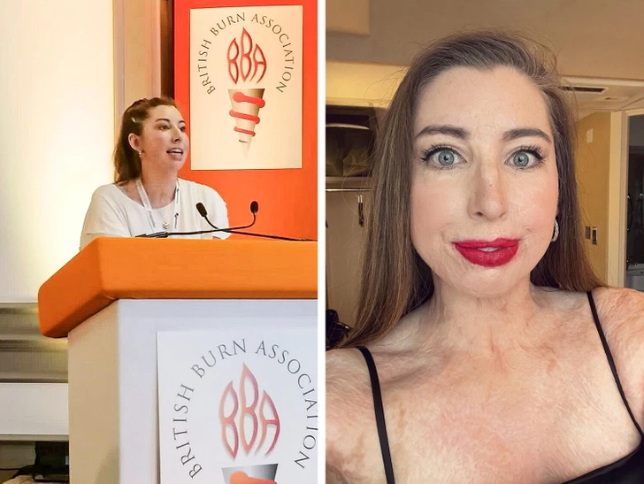 Silný príbeh ženy, ktorá prežila popáleniny na 96% tela a dnes je ...