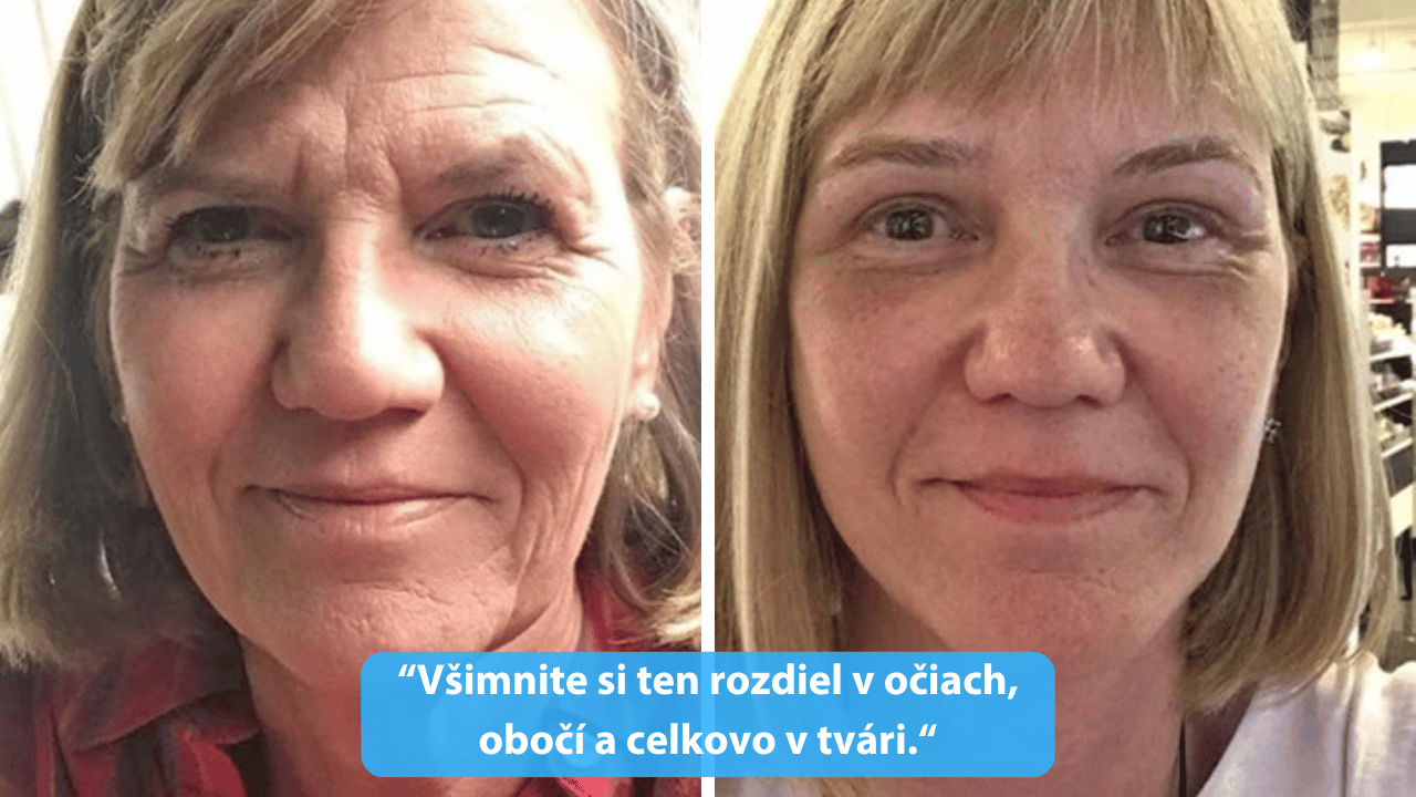 10 ľudí, ktorí sa rozhodli ukázať, ako vám vie plastická operácia ...