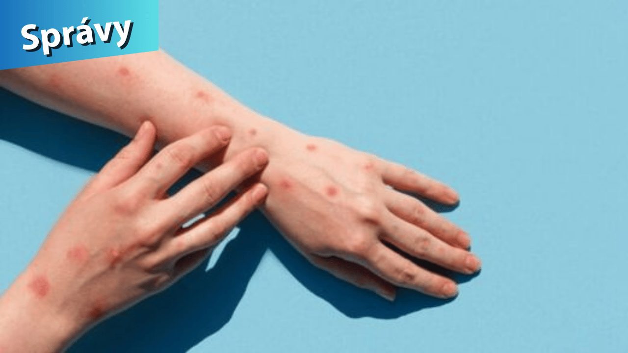 Opičie kiahne sa šíria čoraz viac, obavy vyvoláva nový, smrteľnejší ...