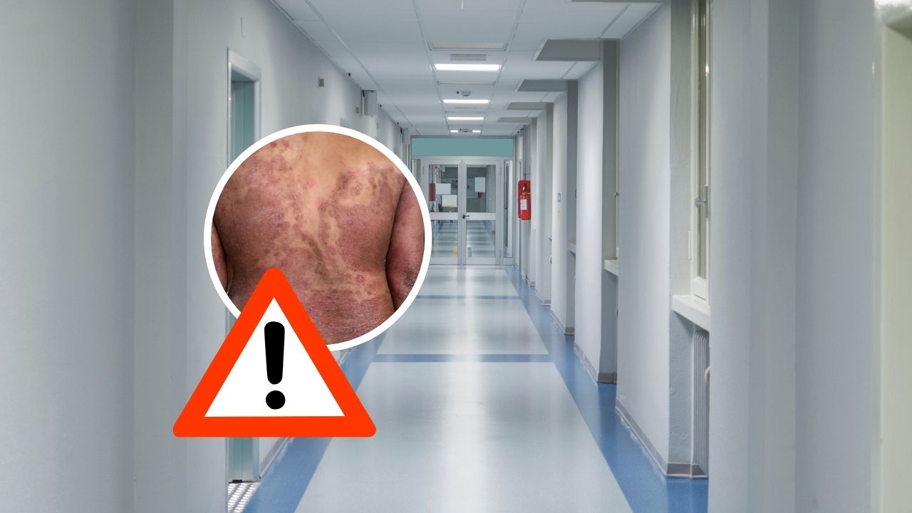 Európou sa šíri nebezpečná „superpleseň“. Lekári varujú, že pred ňou už ...